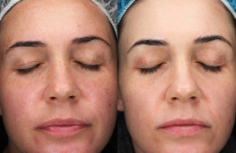 Sciton Moxi Laser Treatments In Dallas Tx Omni Sculpt Md