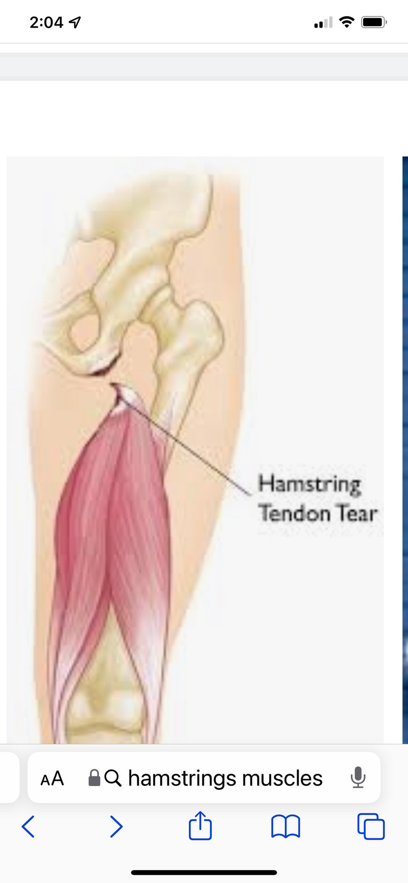 hamstring-tear-the-orthobiologic-clinic