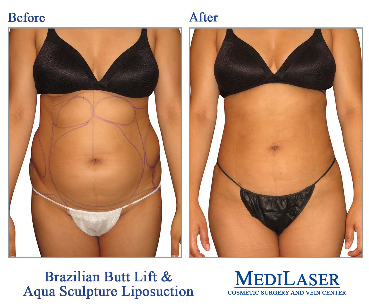 BBL Before & After | Medilaser | Frisco, TX