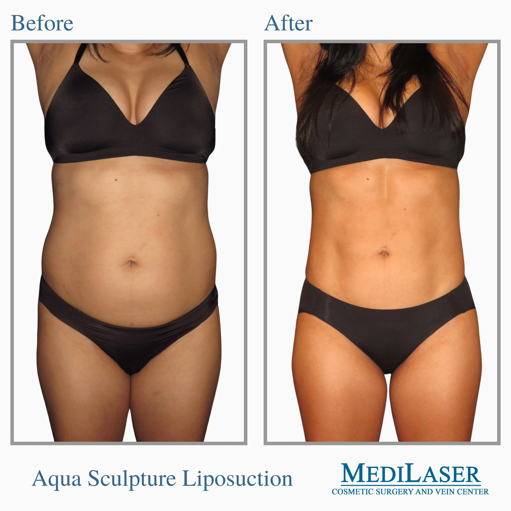 Liposuction Before And After Medilaser Surgery And Vein Center