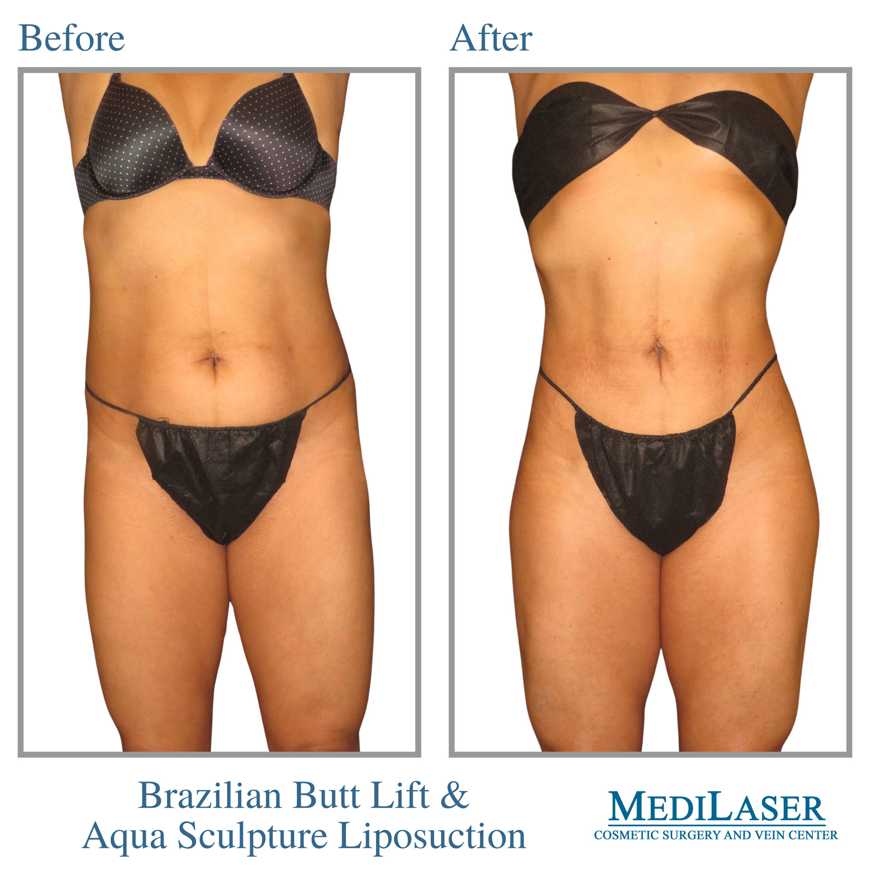BBL Before & After | Medilaser | Frisco, TX