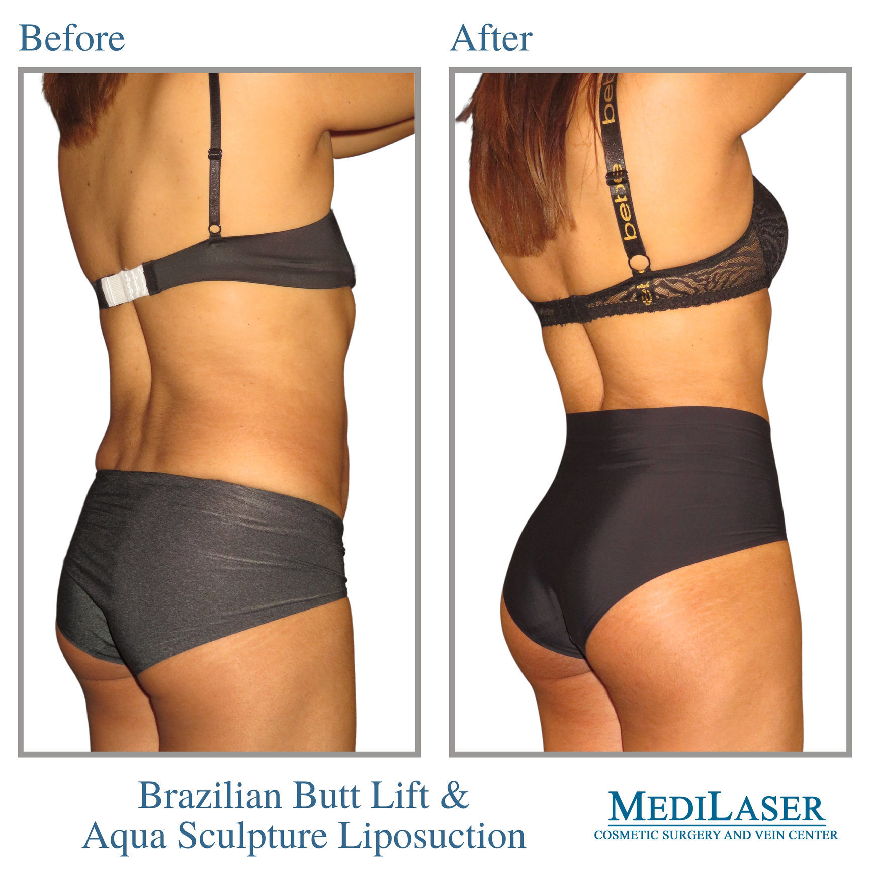 BBL Before & After | Medilaser | Frisco, TX